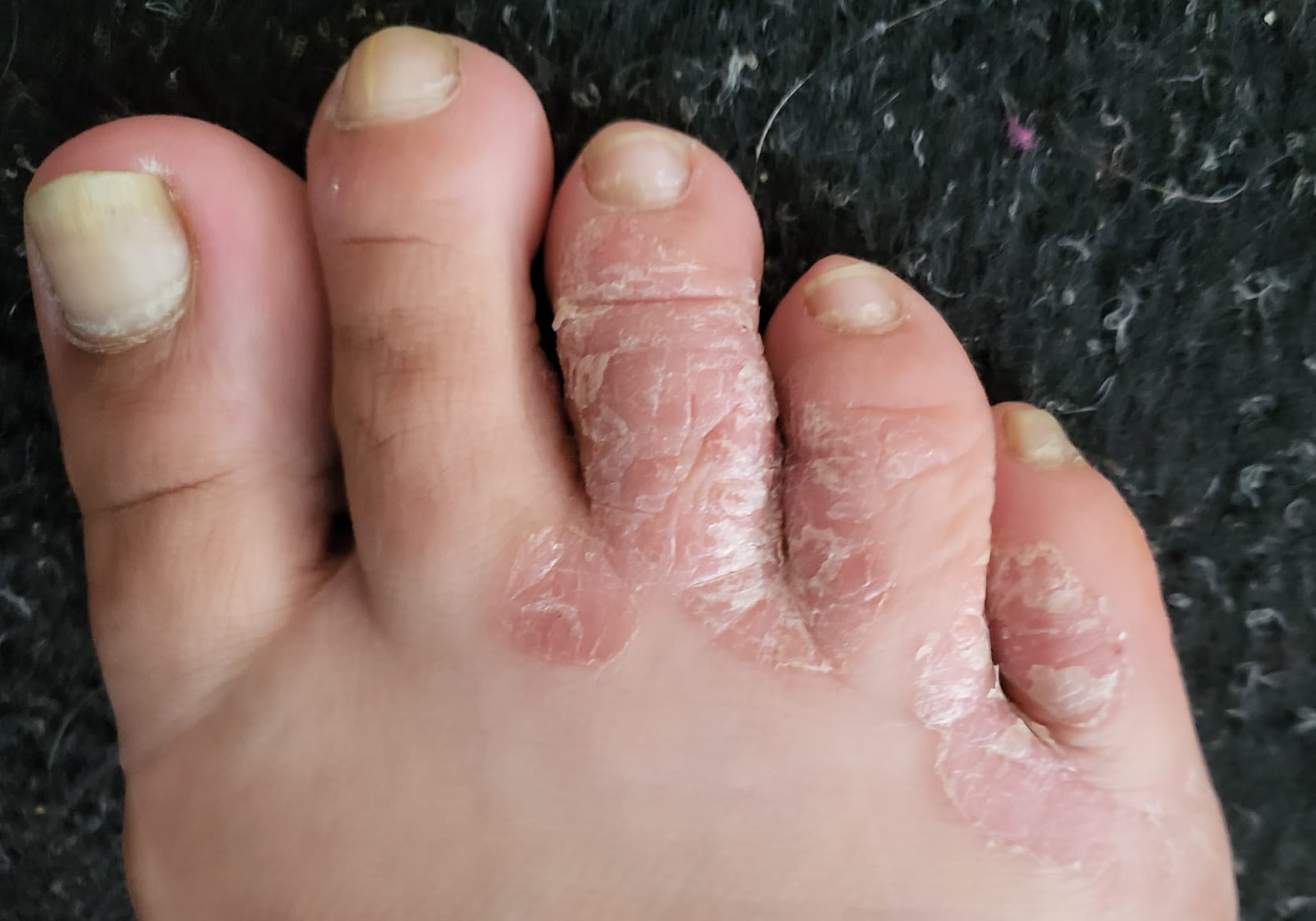 Ciuperca piciorului si micoza unghiei – Argila Albastra